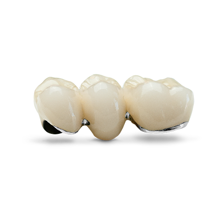 Porcelain Fused to Metal (PFM) Crown - Find Hong Kong Dentist